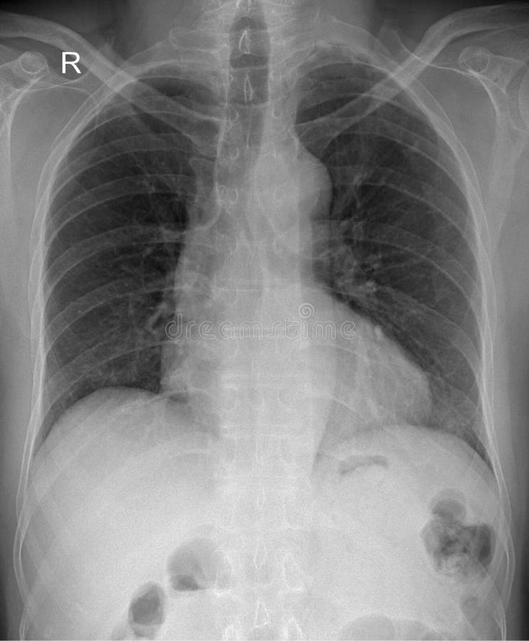 Thoracic Cavity Imaging: How X-Rays Help Diagnose Respiratory Disorders ...