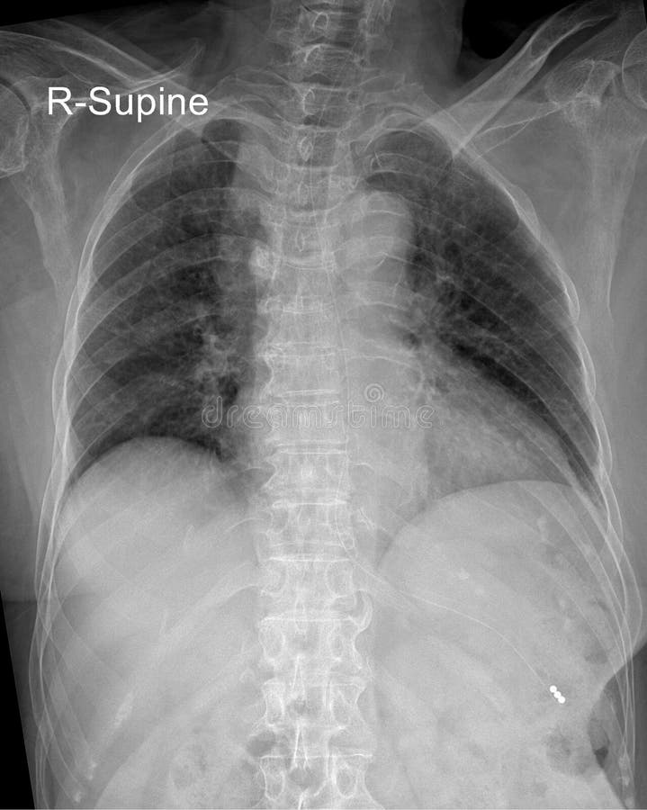 Thoracic Cavity Imaging: How X-Rays Help Diagnose Respiratory Disorders ...