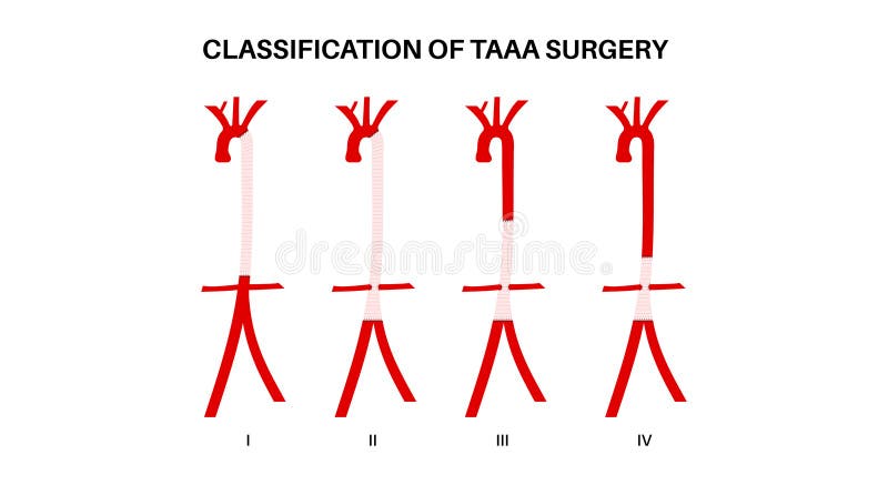 Thoracoabdominal Aortic Aneurysm Surgery Classification Stock ...