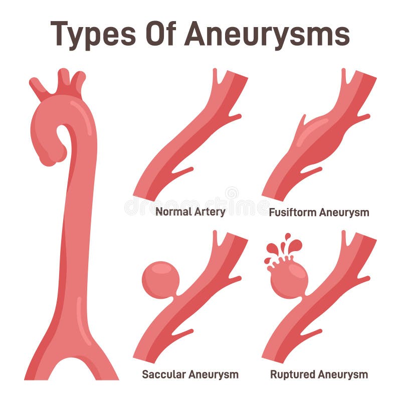Thoracoabdominal Aortic Aneurysms Types. Healthy Aorta and Aorta Stock ...
