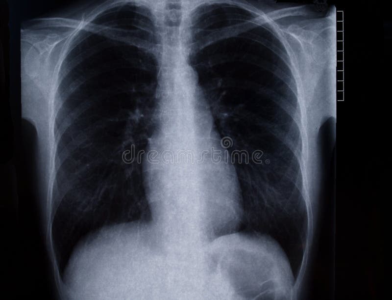 Thorax radiography stock image. Image of back, diagnoses - 25300429