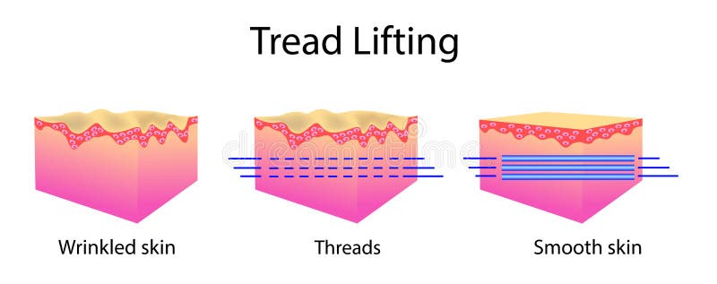 Illustration of Meso Threads Lifting Stock Vector - Illustration of ...