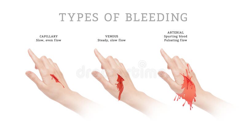 Three Main Types of Bleeding Stock Illustration - Illustration of ...