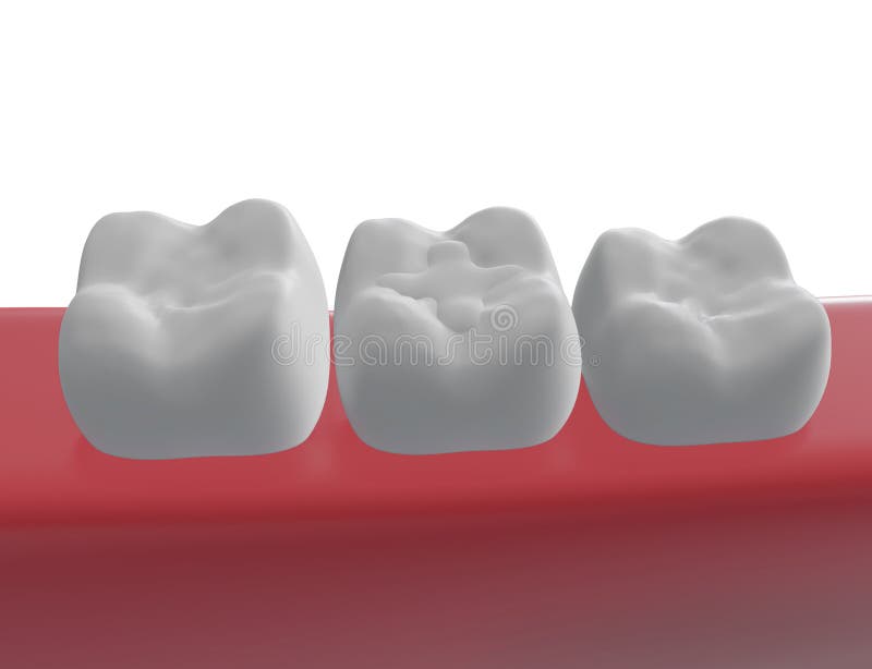Three Teeth in a Row, Three Stages of Tooth Decay Stock Illustration ...