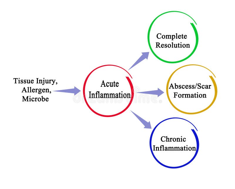 Ways of Resolution of Acute Inflammation Stock Illustration ...