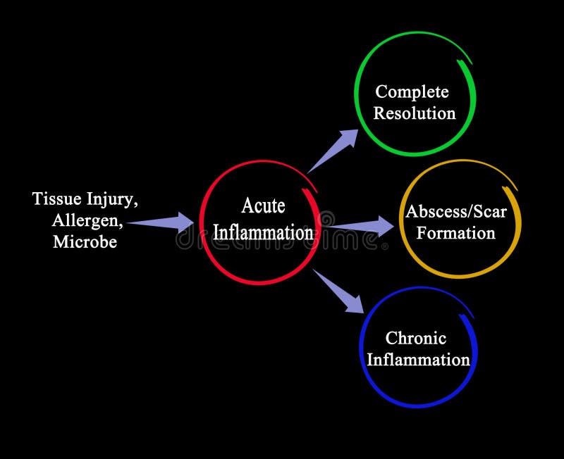 Ways of Resolution of Acute Inflammation Stock Photo - Image of chronic ...