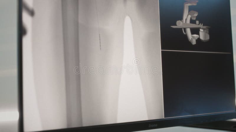 Thrombectomy, Mri Scan Screen. Surgeons Perform an Operation To Remove ...