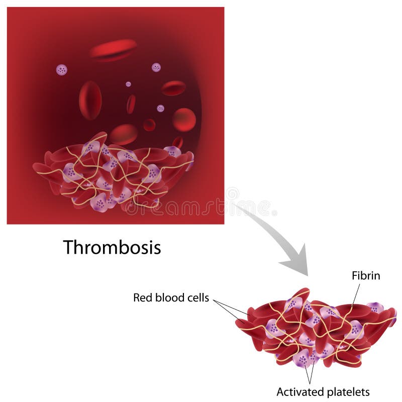 Types of thrombosis stock vector. Illustration of platelets - 27641173