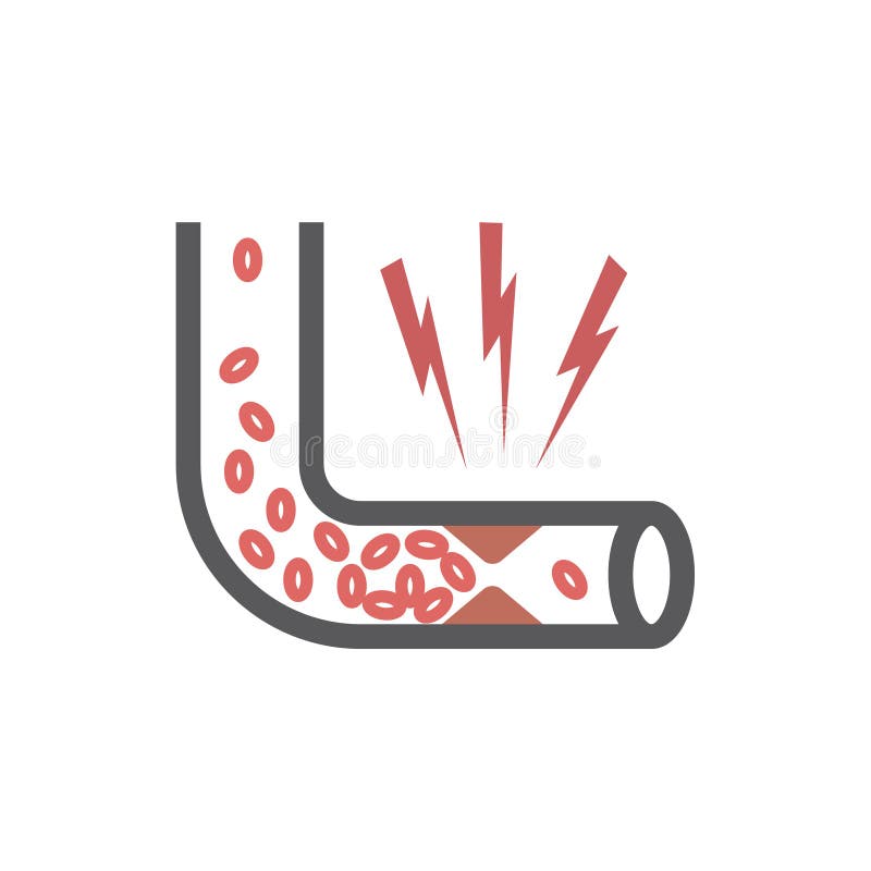 Thrombosis Stock Illustrations – 3,560 Thrombosis Stock Illustrations ...