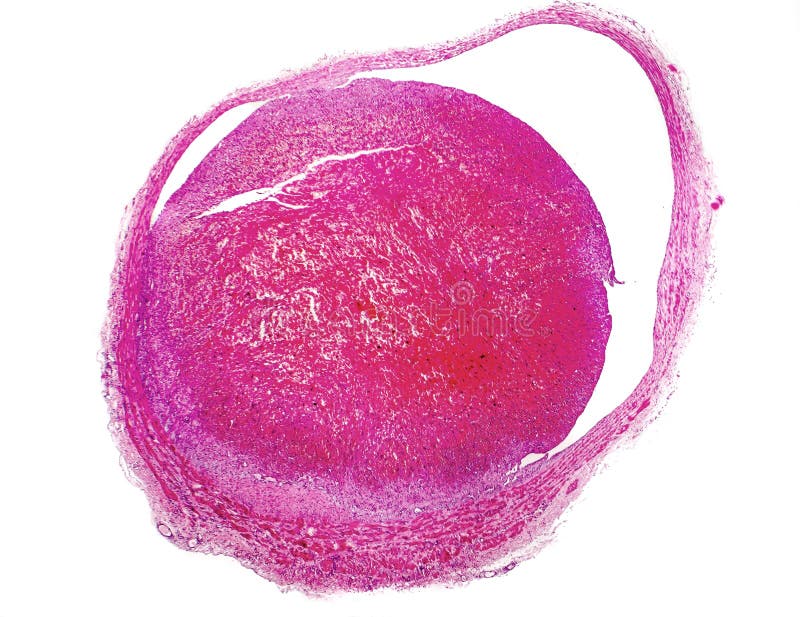 Thrombus Inside Blood Vessel, Light Micrograph Stock Photo - Image of ...