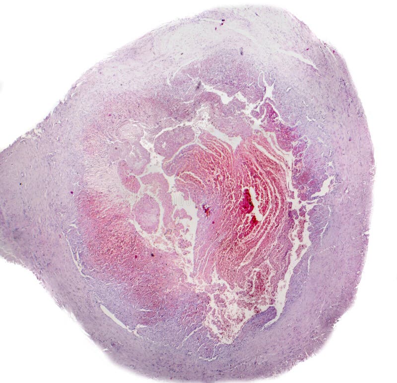 Thrombus Inside Vein, Light Micrograph Stock Photo - Image of ...