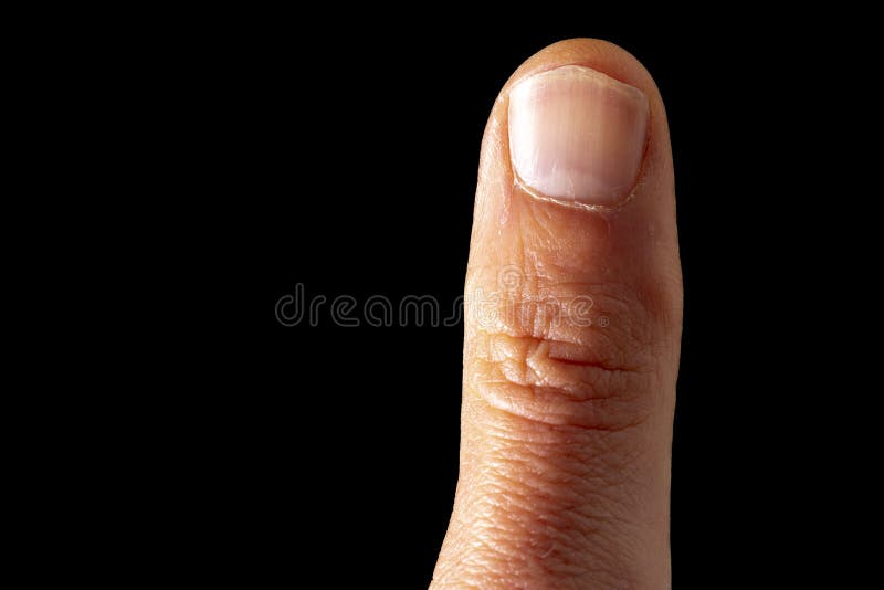 Thumb of Human Hand with Nail Bitten by Teeth Under Black Background ...