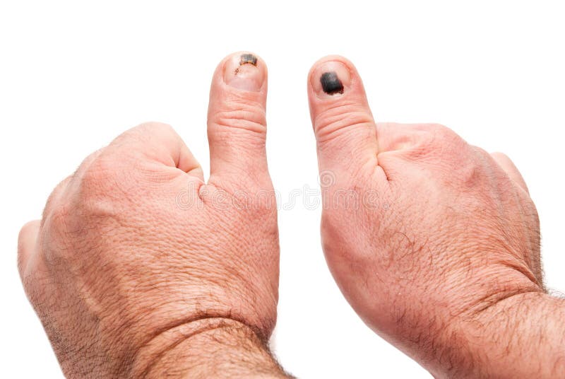 Thumbs with injury stock image. Image of accident, concept - 23090595