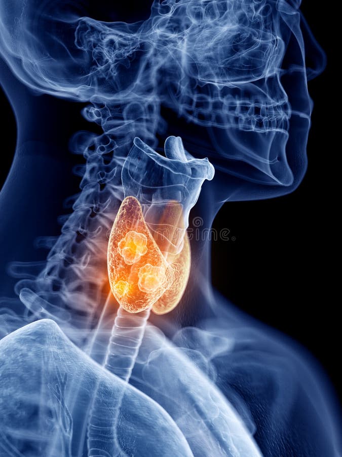 Thyroid cancer stock illustration. Illustration of accurate - 73539793