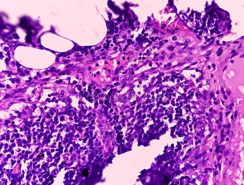 Thyroid Cancer. Tracheal Gland Involved by Tumor. Metastatic Papillary ...