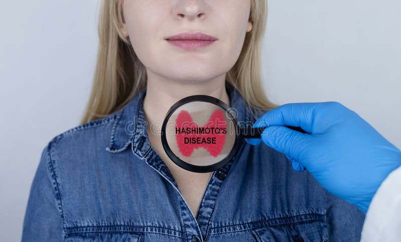 Thyroid Disease - Autoimmune Thyroiditis, Hashimoto S Disease. the ...