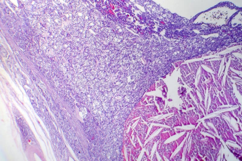 Thyroid Follicular Carcinoma, Light Micrograph Stock Image - Image of ...