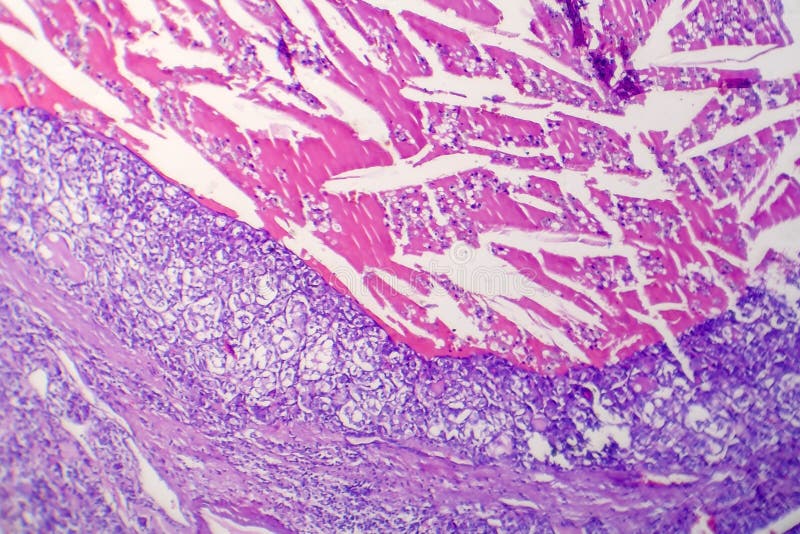 Thyroid Follicular Carcinoma, Light Micrograph Stock Image - Image of ...