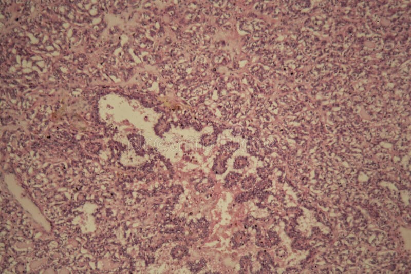 Thyroid Gland Cells Under the Microscope Stock Photo - Image of ...