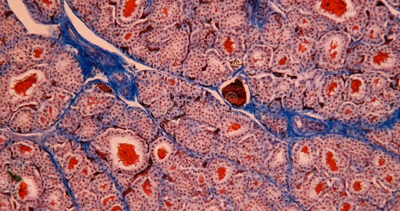 Thyroid gland with colloid stock footage. Video of colloid - 204492678