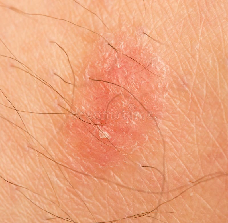 Hongo en piel humana Macro foto de archivo. Imagen de piel - 100860328