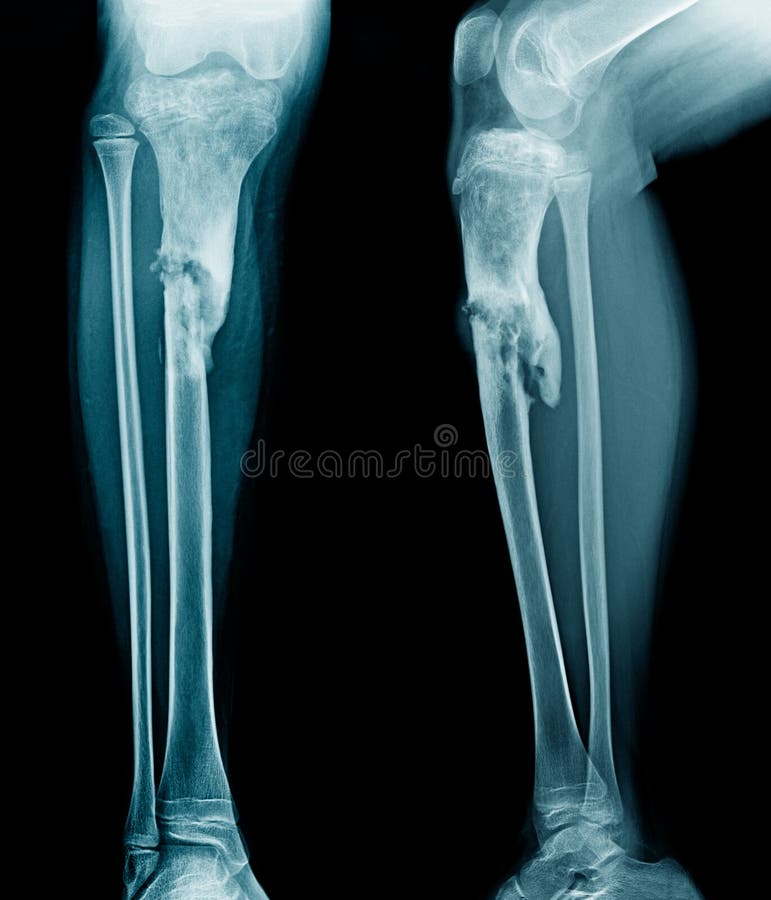 2,141 Tibia Fotos de stock - Fotos libres de regalías de Dreamstime