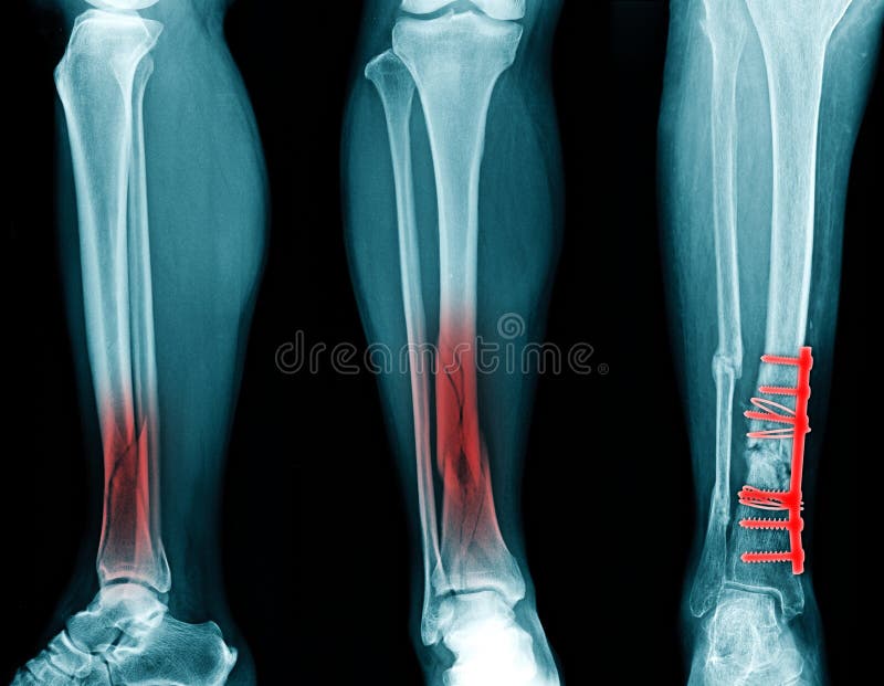 Fessura Dell'osso Fibular E Tibial Fotografia Stock - Immagine di ...