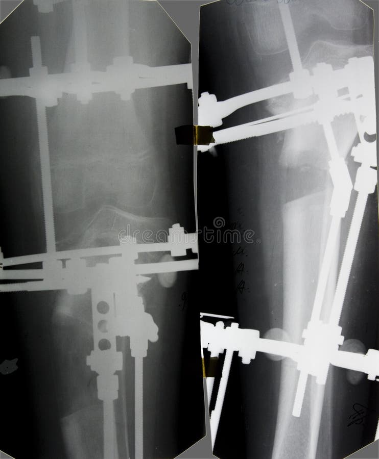 Tibia x-ray picture stock image. Image of osteoporosis - 19143253