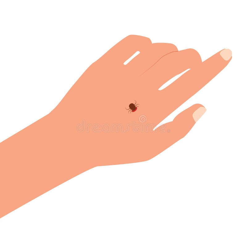 Tick ??bite. Tick on a Human S Hand. Healthcare Illustration Stock ...