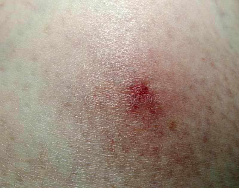 Tick bite stock image. Image of lyme, infection, protective - 39055915