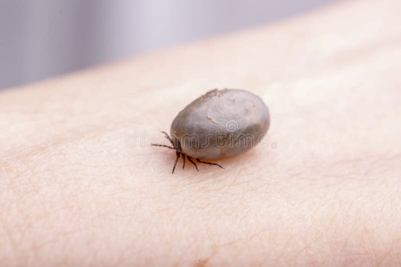 Tick Drunk Blood on the Skin 2020 Stock Photo - Image of irritation ...