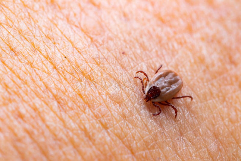 Tick Filled with Blood on Human Skin Stock Image - Image of human ...