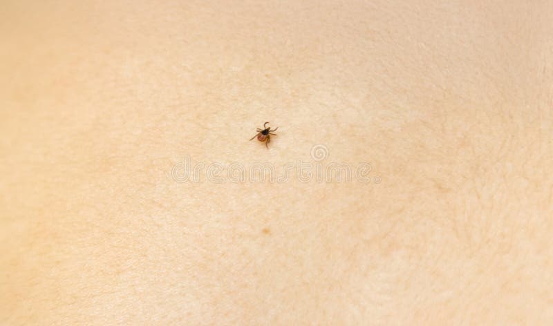 Tick on Human Body. Selective Focus Stock Image - Image of infection ...
