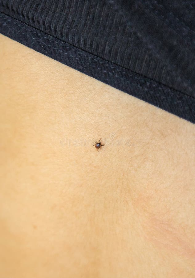 Tick on Human Body. Selective Focus Stock Photo - Image of bite, lyme ...