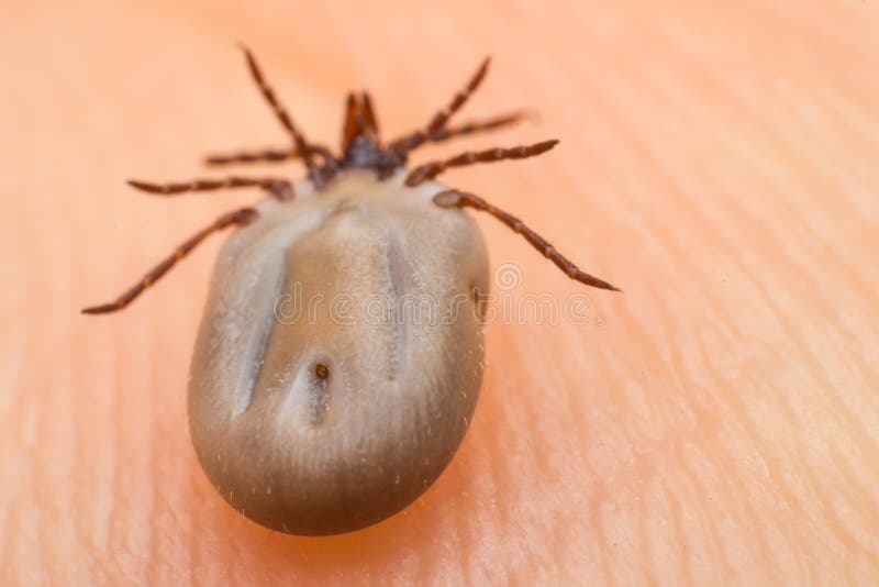 Fat tick on human skin stock image. Image of skin, lyme - 148977625