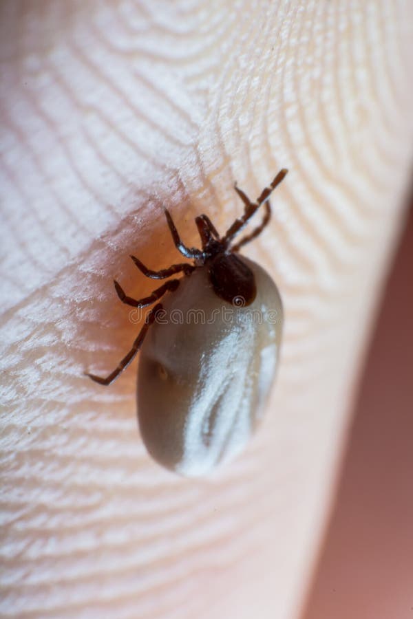 Tick on the Human Skin Surface Stock Image - Image of romania, borrelia ...