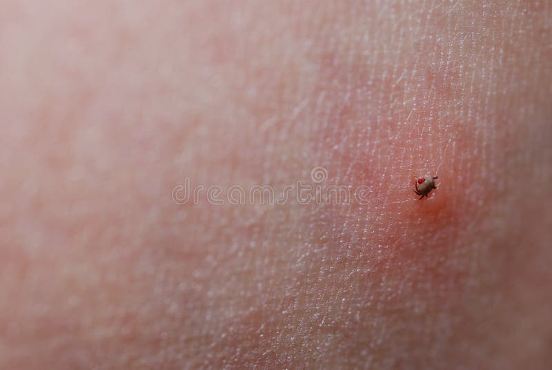 Tick and skin stock photo. Image of insect, teamwork - 31436776