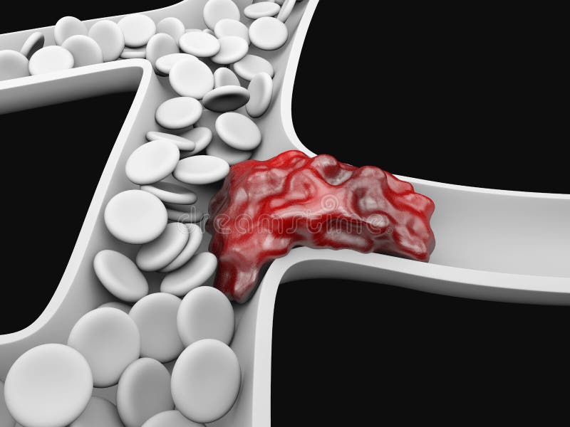 Thrombosis Von Der Normalen Durchblutung Zur Blutgerinnselbildung Stock ...