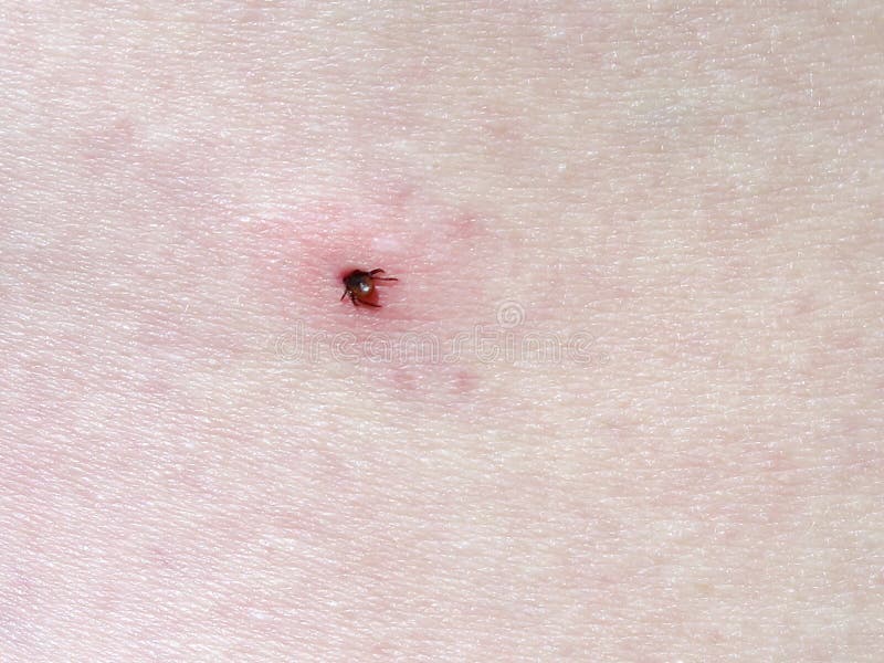 Teek, Insect, Insectenbeet, Parasiet Stock Foto - Image of slecht, eten ...