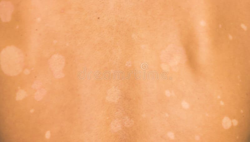 Tinea is the Back Plate is Expanding. Stock Photo - Image of ...