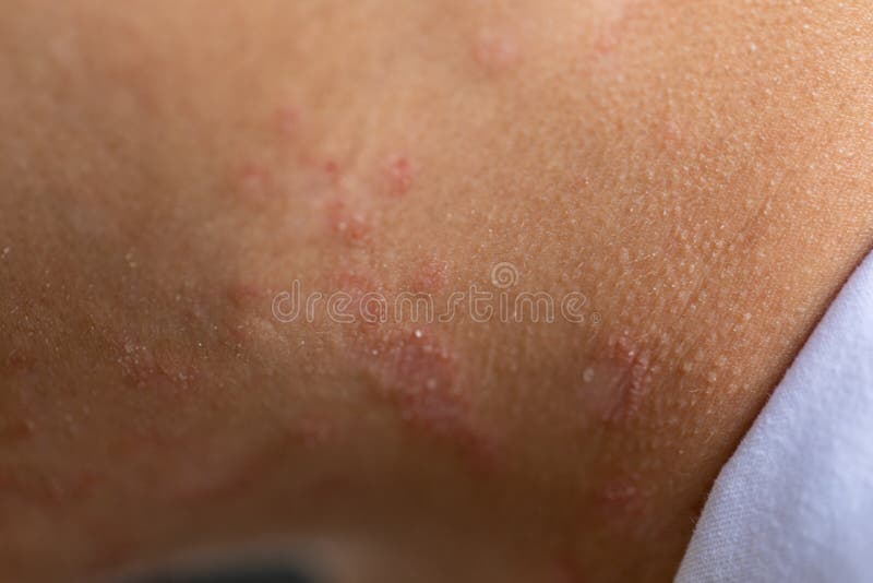 Tinea Circinata or Ringworm . Stock Image - Image of care, circinata ...