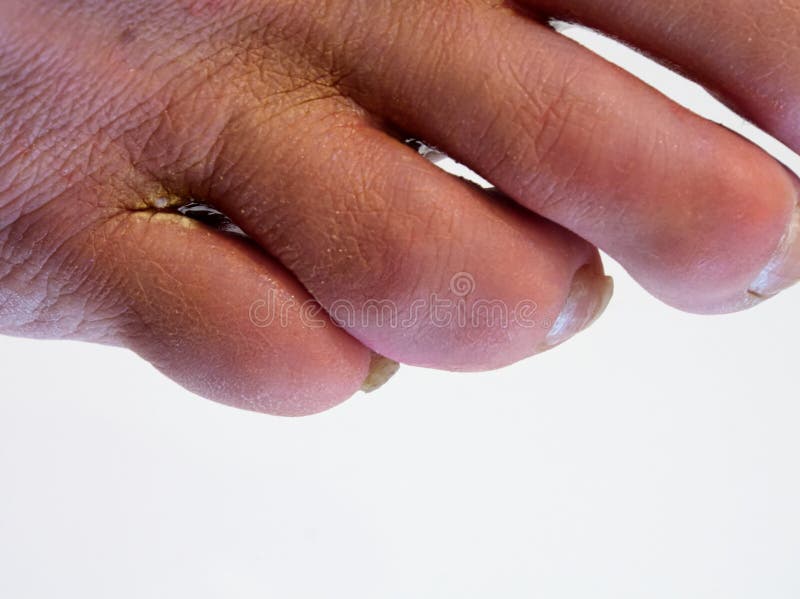 Psoriasis Dermatitis Atópica Sequedad De Piel De Los Dedos De Los Pies ...