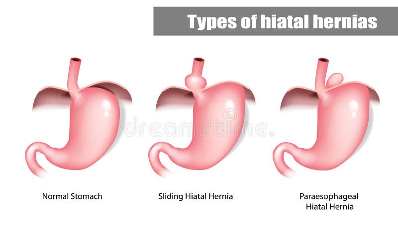 Tipi Di Ernie Epigastrico, Laterale, Ombelicale, Inguinale, Femorale ...