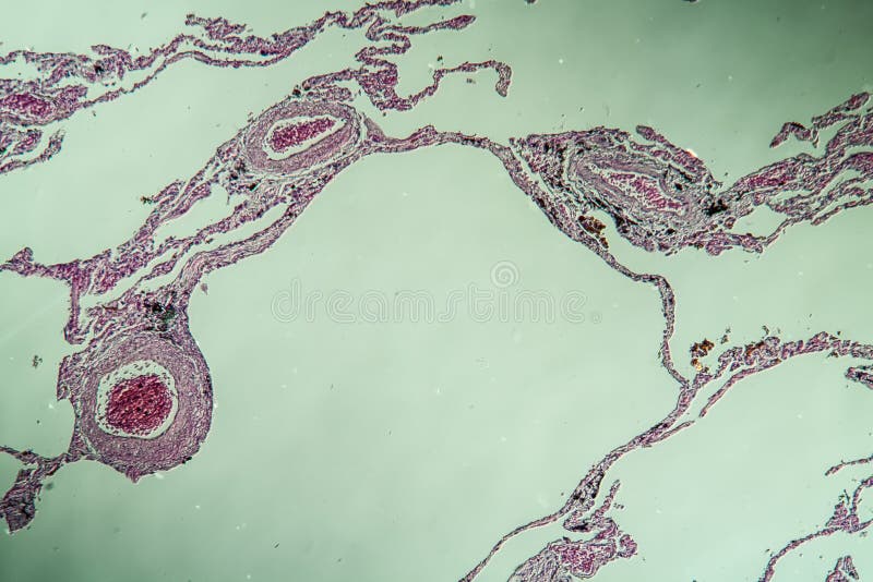 Tissue Contaminated with Asbestosis Stock Photo - Image of hornblende ...