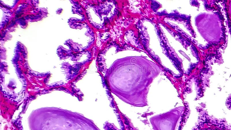 Tissue of Enlarged Prostate, Light Microscopy Stock Video - Video of ...