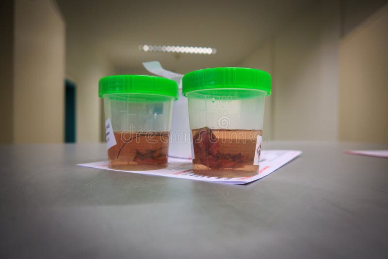 Tissue Samples are Placed in Formalin for Subsequent Examination by a ...