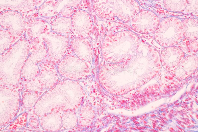 107 Stomach Cancer Cells Under Microscope Stock Photos - Free & Royalty ...