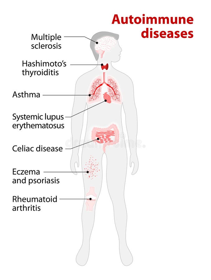 Systemic Lupus Erythematosu Stock Vector - Illustration of labeled ...