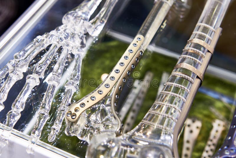 Titanium Plates for Splicing Bones Stock Photo - Image of fixed ...