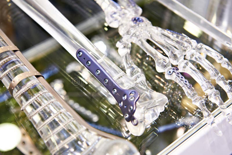 Titanium Plates for Splicing Bones Stock Photo - Image of fixation ...